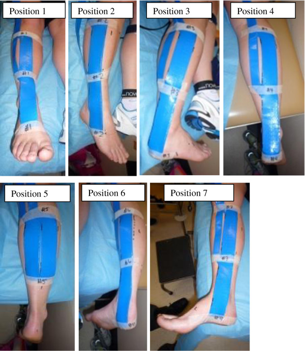 M-Med Total Contact Casting | A novel approach to mapping load transfer ...